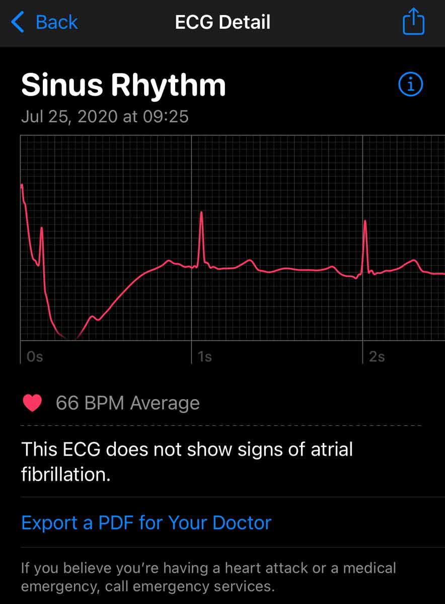 How to use the Irregular Heart Rhythm notification feature on Apple ...