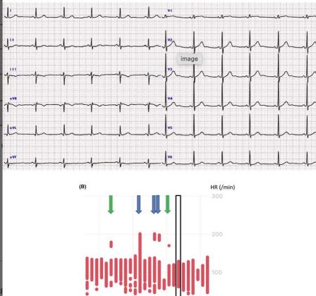 Apple Watch can help detect SVT (Supraventricular Tachycardia) and help ...