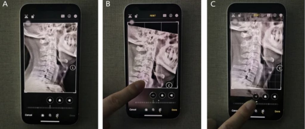 iPhone’s photo edit function helps with diagnosing unique cervical ...